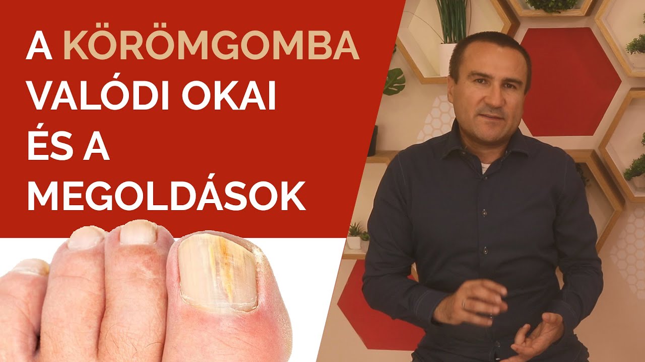 Körömgomba kialakulásának valódi okai. Körömgomba tünetei, körömgomba ...
